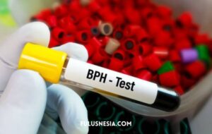 ICD 10 BPH (Prostat) - Kode & Penjelasan Lengkap! - FulusNesia